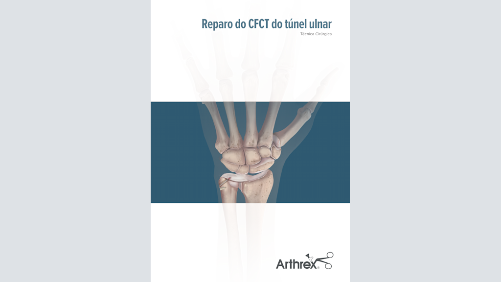 Arthrex - Bio-Tenodesis™ Screw System