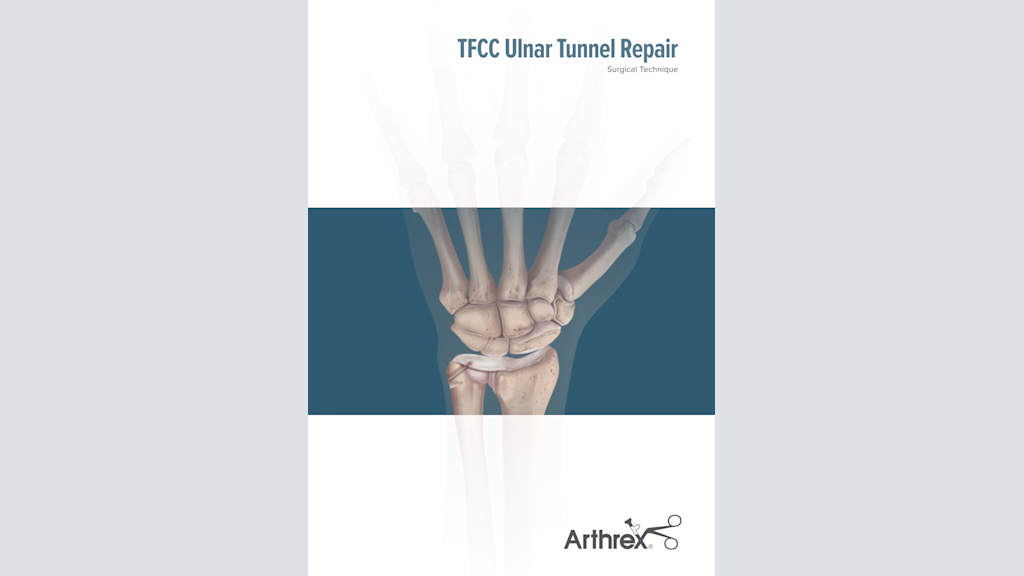 Arthrex - Arthroscopic Knotless TFCC Repair Using the PushLock® Anchor