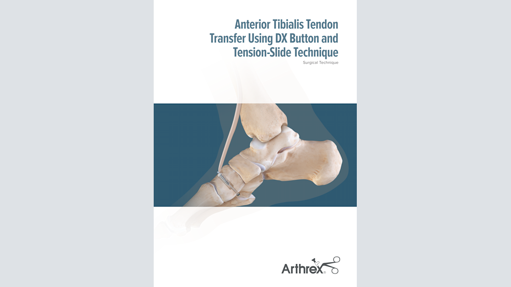 Arthrex - FHL Tendon Transfer