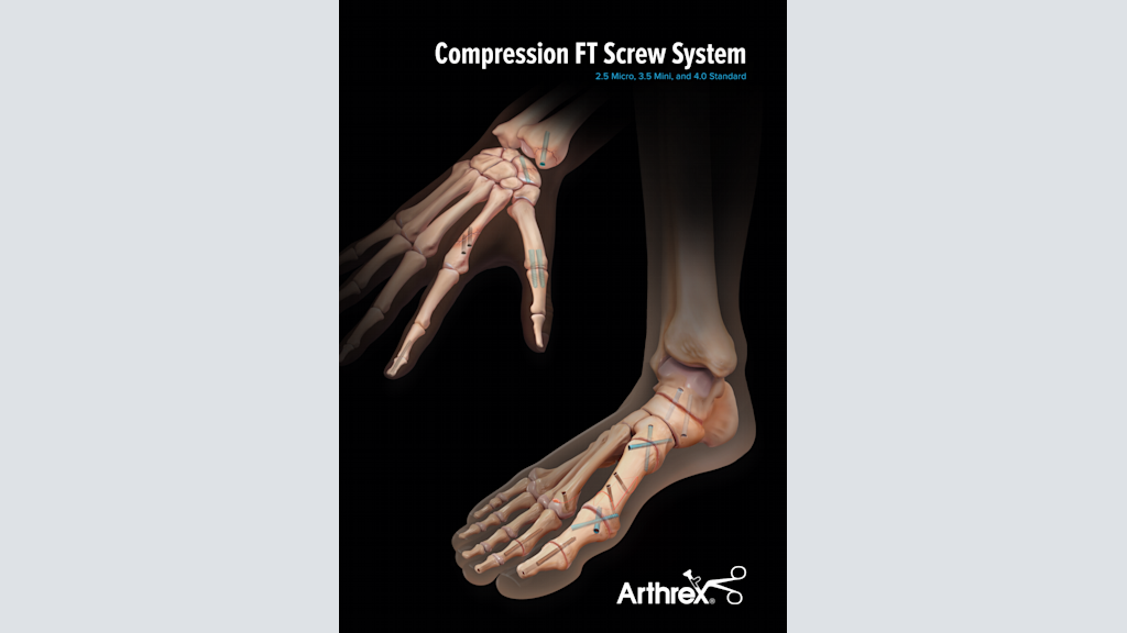 Arthrex - MTP Joint Arthrodesis