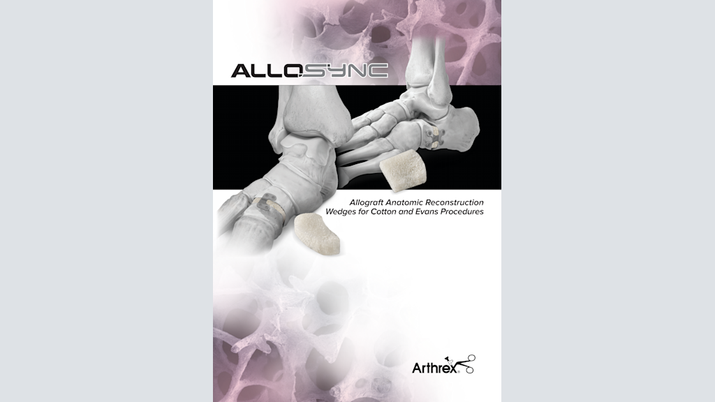 Arthrex - AlloSync™ demineralisierte Knochentransplantate
