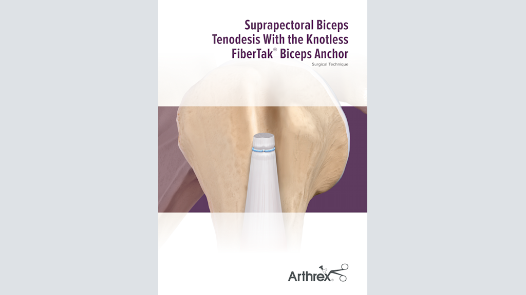 Arthrex - Knotless FiberTak® Biceps Tenodesis