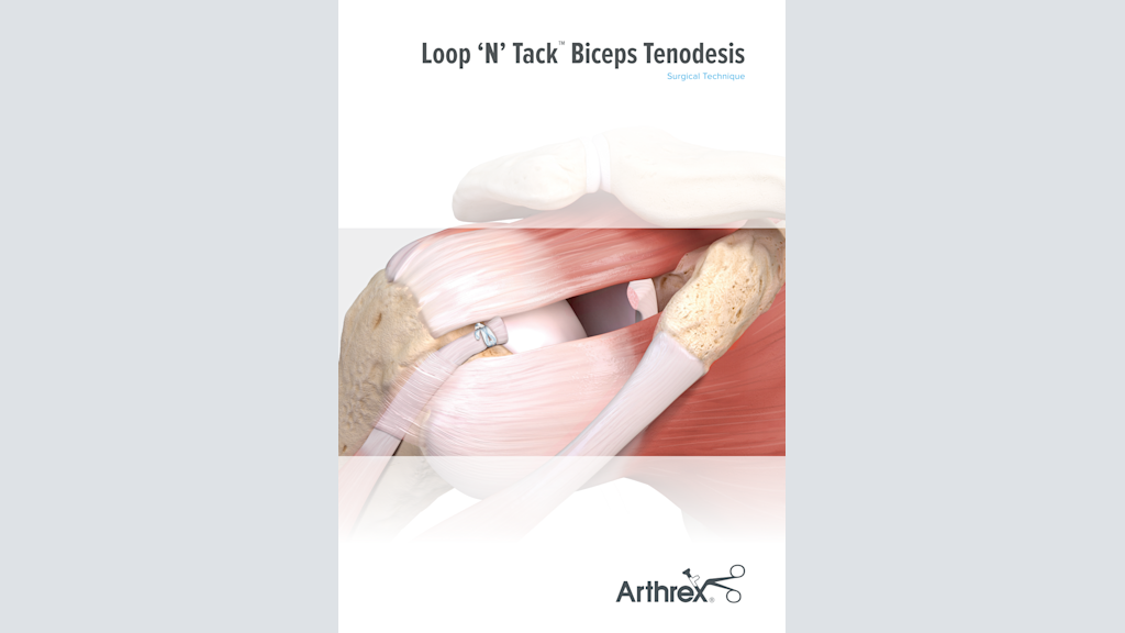 Arthrex - Loop 'N' Tack™ Biceps Tenodesis Technique