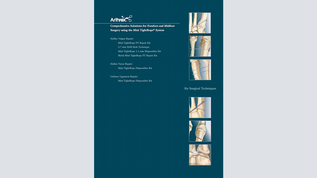 Arthrex - Mini TightRope® Technique for Hallux Varus