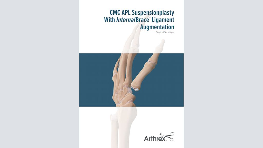 Arthrex - InternalBrace™-Implantatekit zur Bandaugmentation an Hand ...