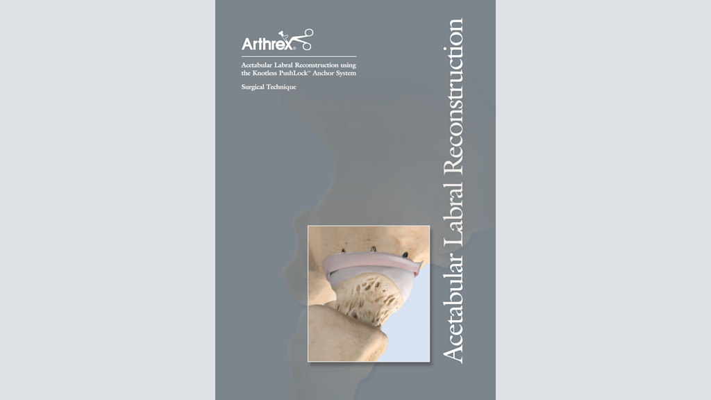 Arthrex Labral Fixation