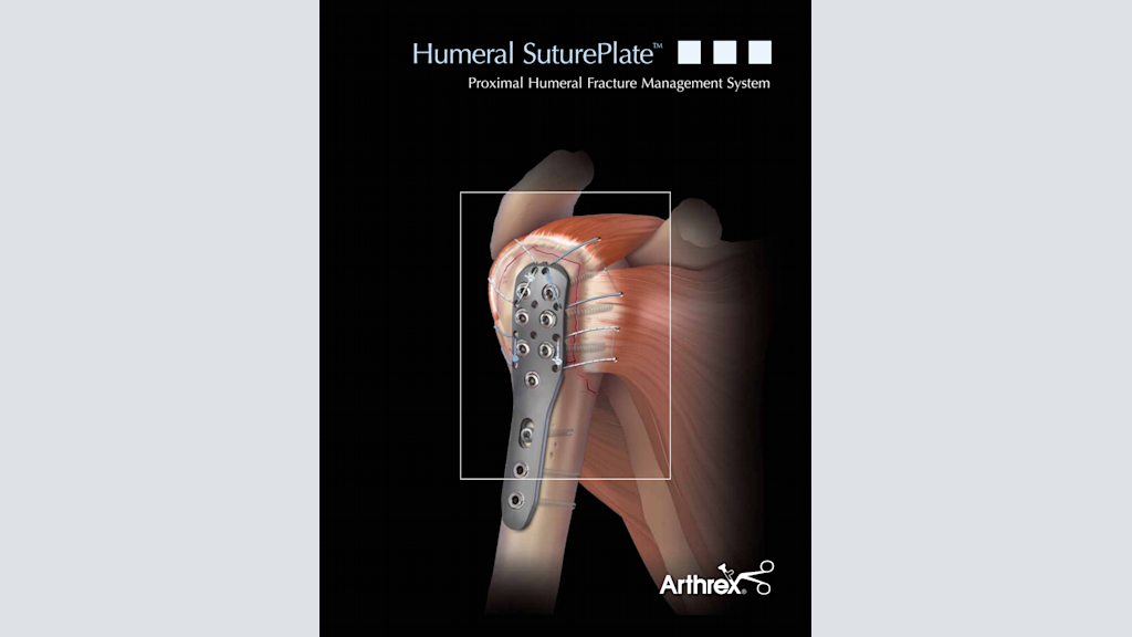 Arthrex - Humeral SuturePlate™ Repair
