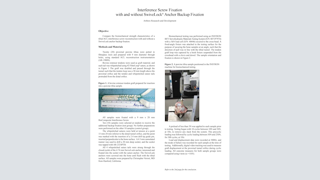 Arthrex - ACL Backup Fixation System