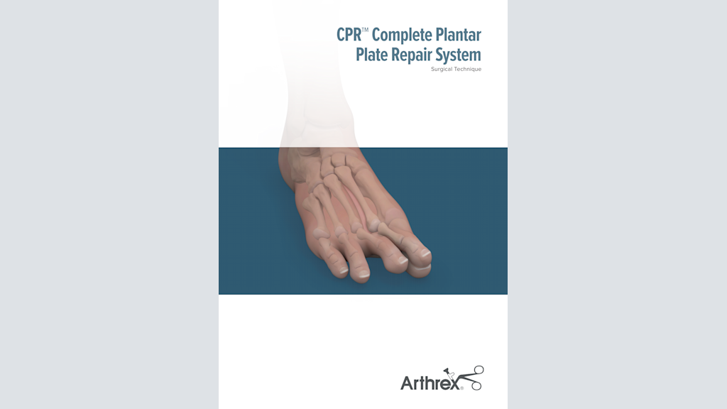 Arthrex - Osteotomia para encurtamento metatarsal