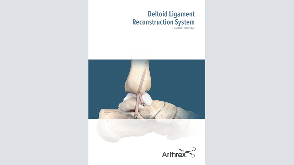 Arthrex - Deltoid Ligament Reconstruction