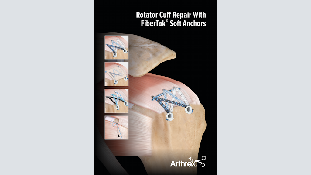 Arthrex - FiberTak® SpeedBridge™ Rotator Cuff Repair