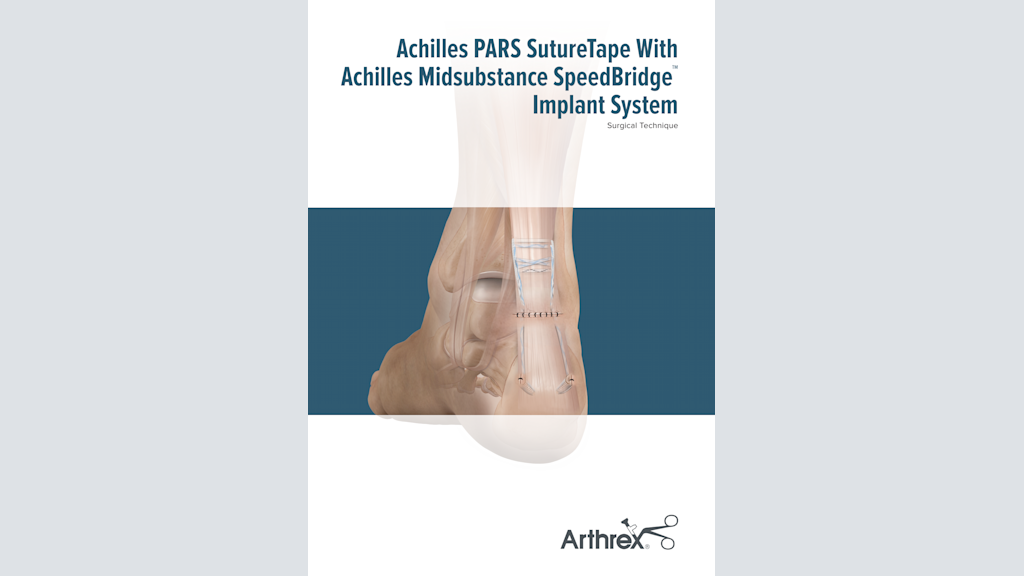 Arthrex - PARS SutureTape Technique for Achilles Rupture