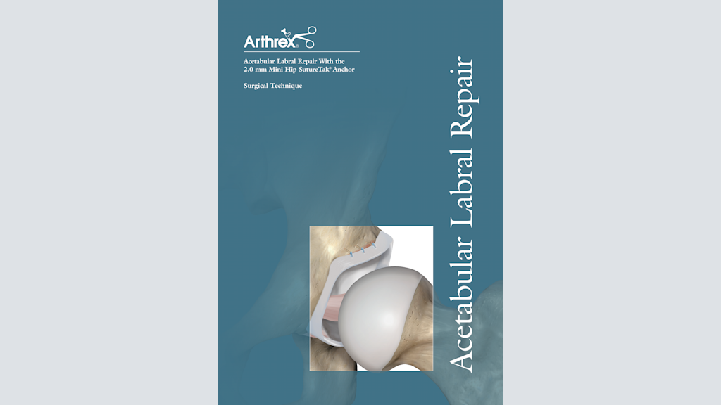 Arthrex - SutureTak® Suture Anchor