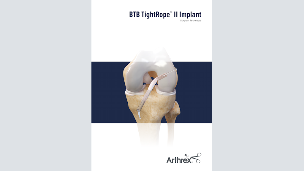 Arthrex - TightRope® II BTB Implant