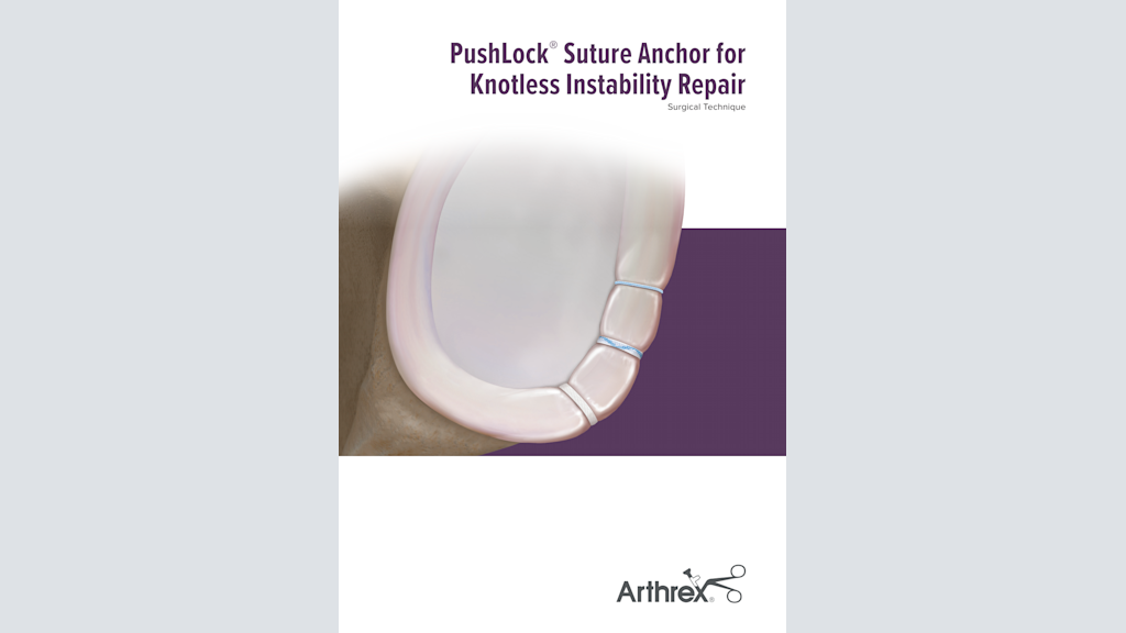 Arthrex - PushLock® Anchor