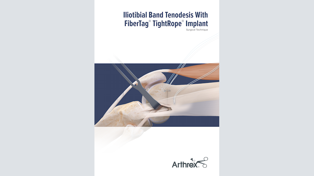 Arthrex - Iliotibial Band Tenodesis