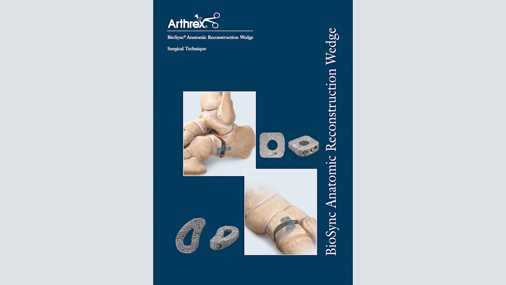 Arthrex - BioSync® Anatomic Reconstruction Wedge