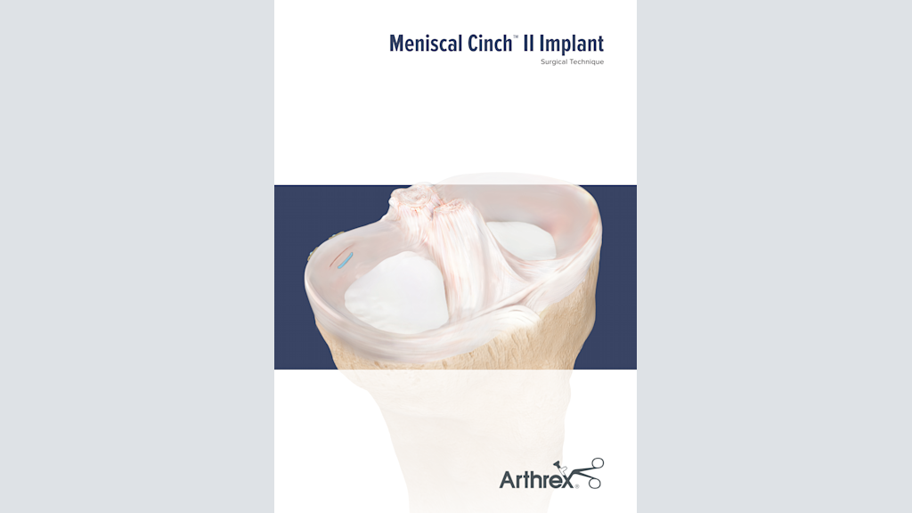 Arthrex - Meniscal Cinch™ II Technique