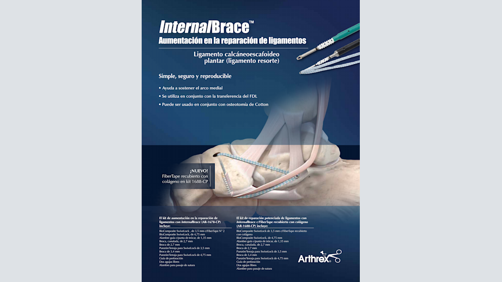 Arthrex - Técnica de reparación de Brostrom con InternalBrace™