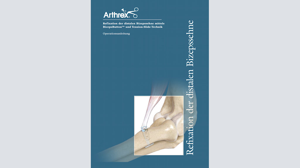 Arthrex - Tension-Slide Technique