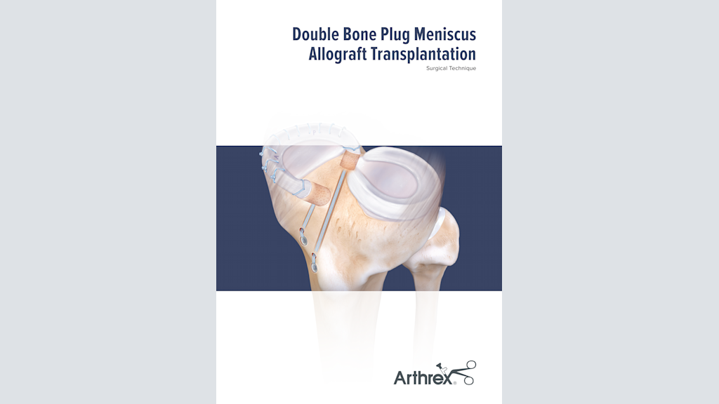 Arthrex - Double Bone Plug Meniscal Transplant
