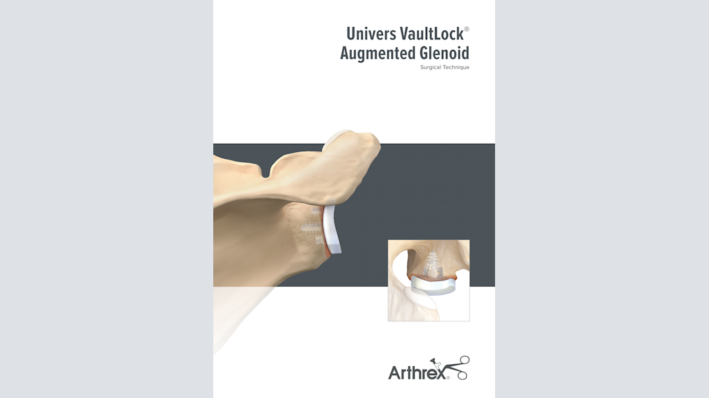 Arthrex - Univers VaultLock® Glenoid System