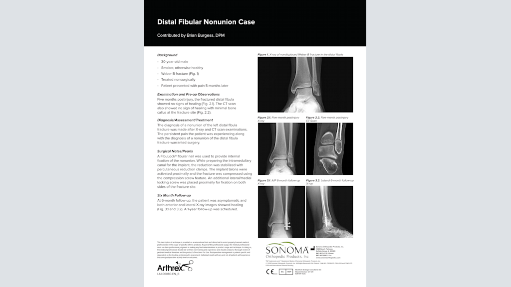 Arthrex - FibuLock® Fibular Nail