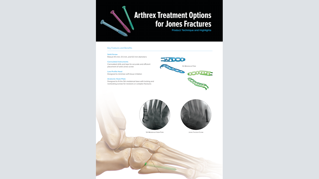 Arthrex - Jones Fracture Repair