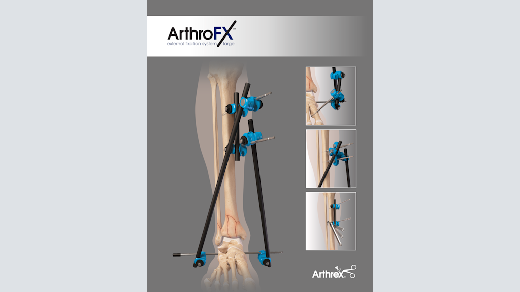 Arthrex - External Fixation