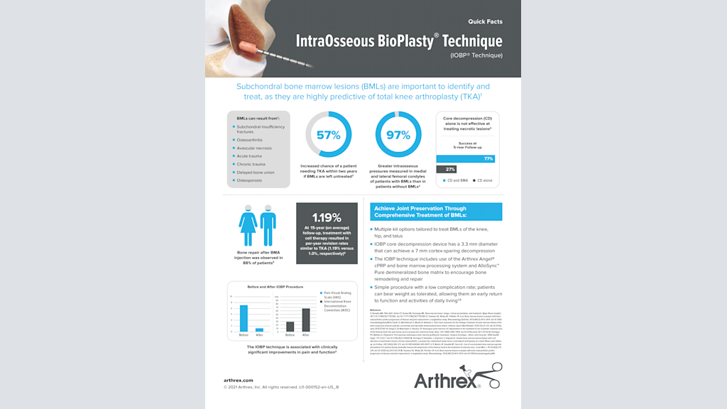 Arthrex - IntraOsseous BioPlasty® (IOBP) Technique