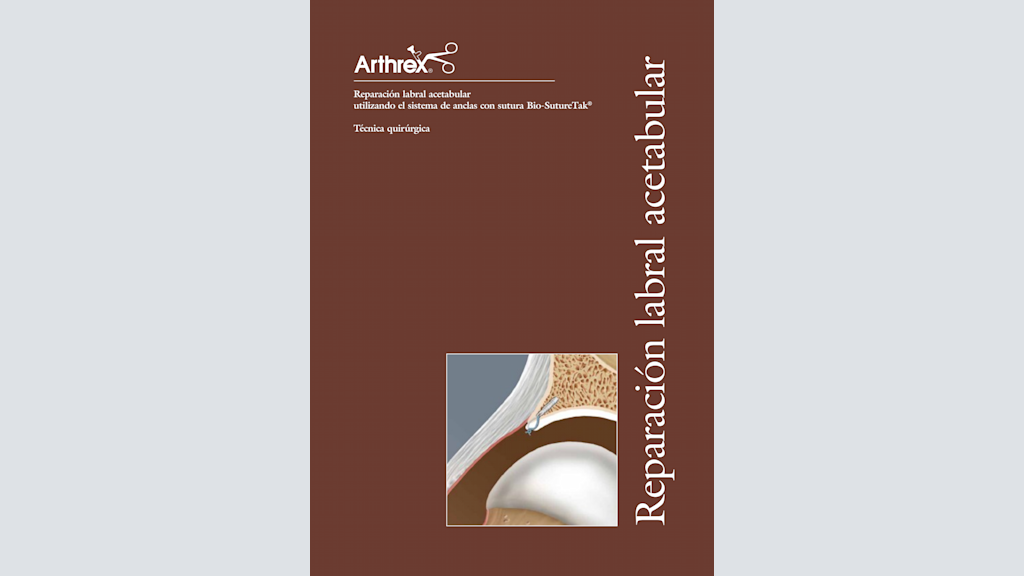 Arthrex - Labral Fixation