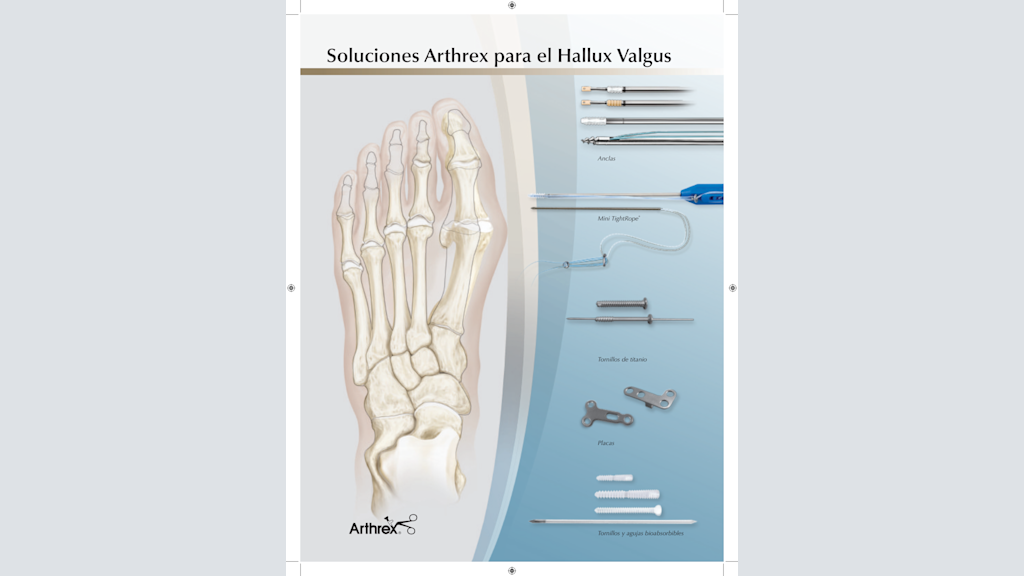 Arthrex - Mini TightRope® Technique for Hallux Valgus
