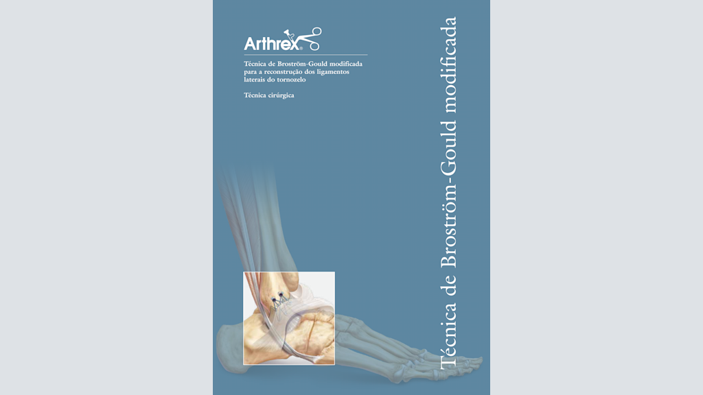 Arthrex - Procedimiento abierto de Brostrom