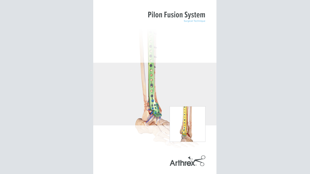 Arthrex - Pilon Fusion Plating System