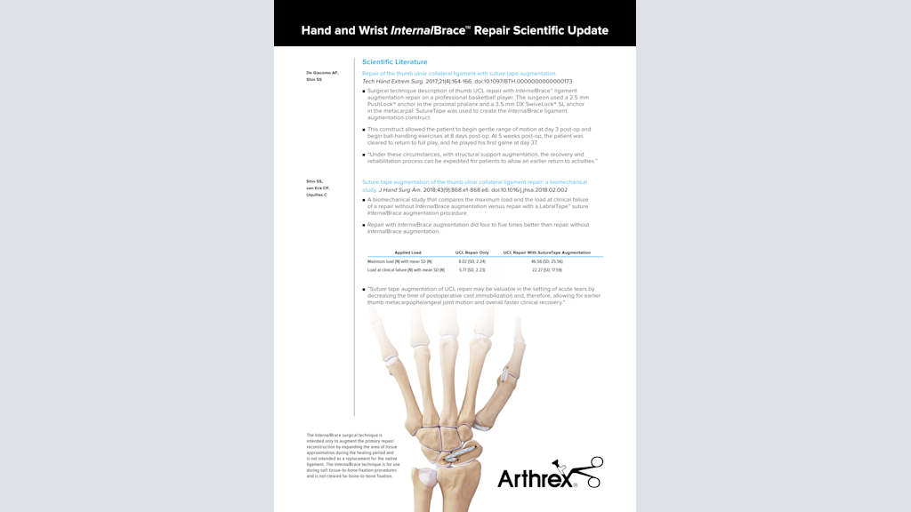 Arthrex - DX SwiveLock® SL Anchor Thumb Collateral Ligament Reconstruction