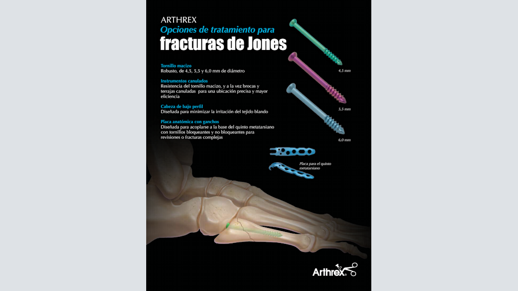 Arthrex - Jones Fracture Repair