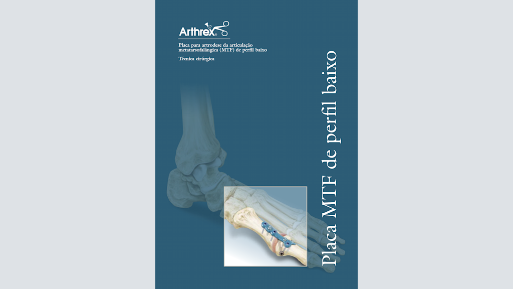 Arthrex - MTP Joint Arthrodesis