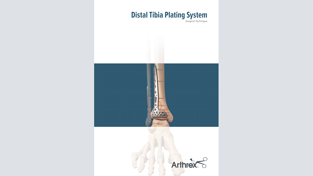 Arthrex - Internal Fixation for Distal Tibia Fracture/Pilon