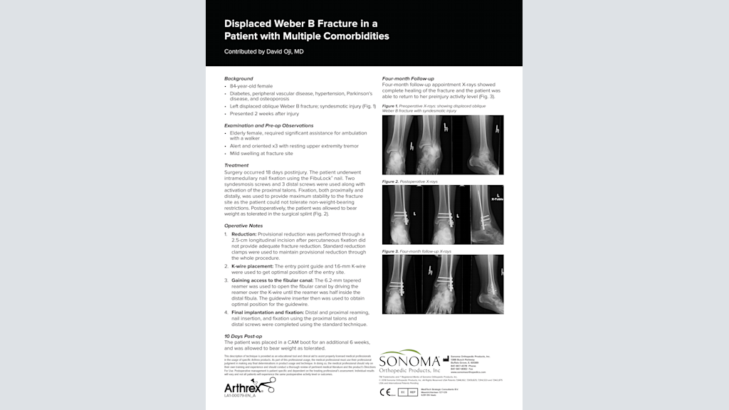 Arthrex - Clavo para peroné FibuLock®