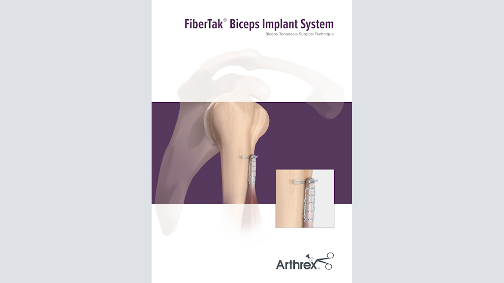 Arthrex - FiberTak® Biceps Tenodesis Technique