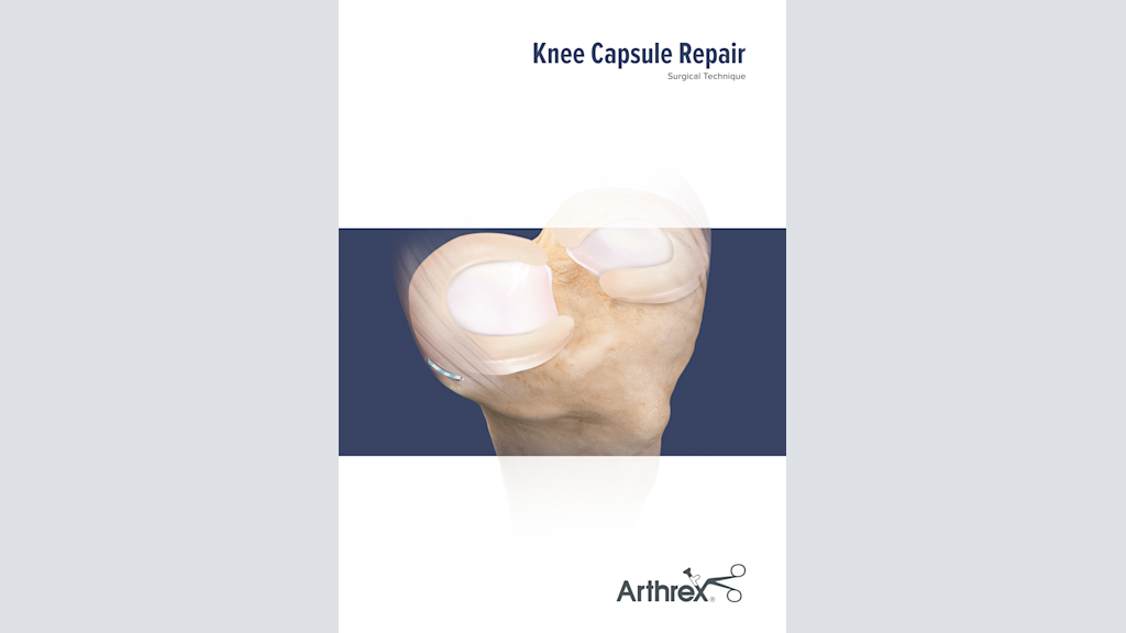 Arthrex - Knee Capsule Repair Surgical Technique