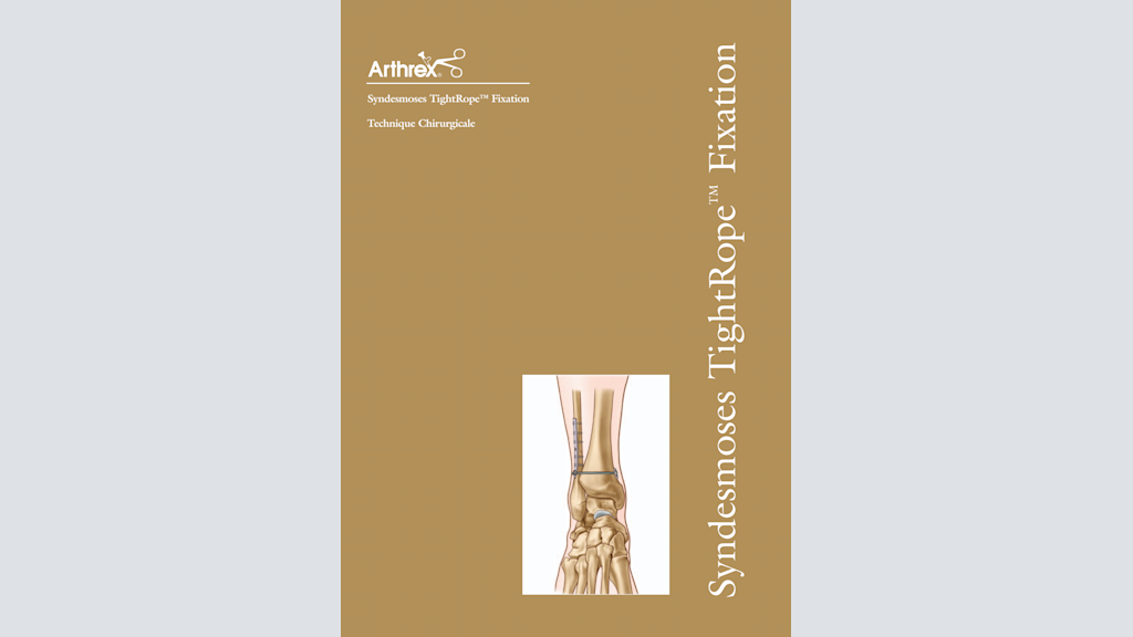 Arthrex - Syndesmosen-TightRope® XP-Implantatsystem