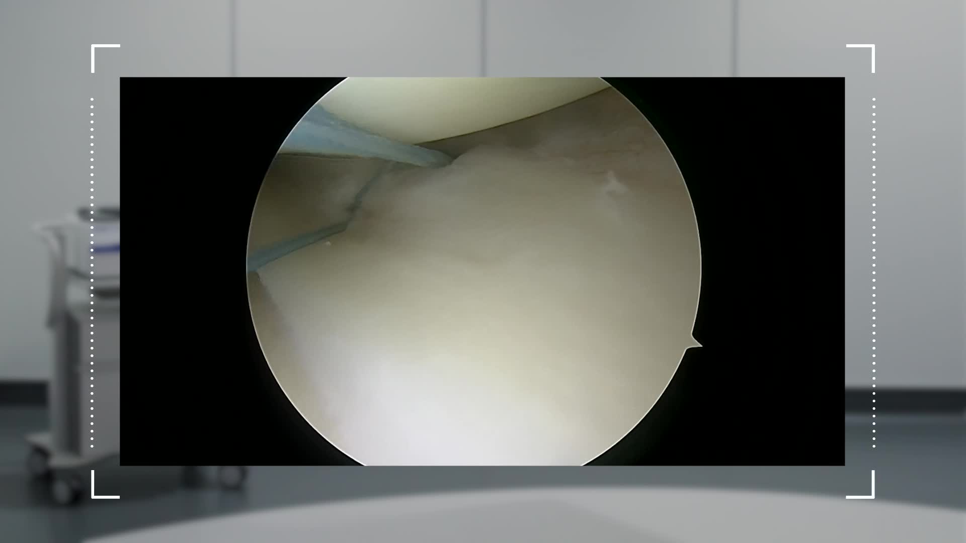 Arthrex - SpeedPearl: FiberStitch™ 1.5 Implant Technique for ...