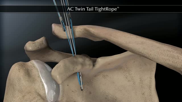 Arthrex - AC Twin Tail TightRope