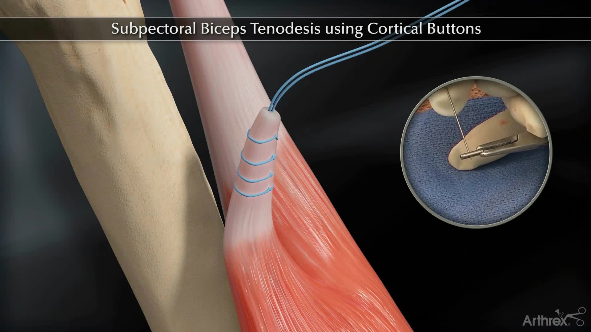 Arthrex - Subpectoral Biceps Tenodesis Using Cortical Buttons