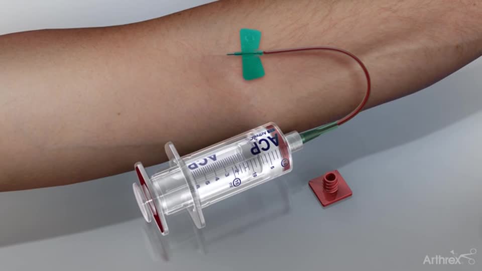 Arthrex - Autologous Conditioned Plasma (ACP)