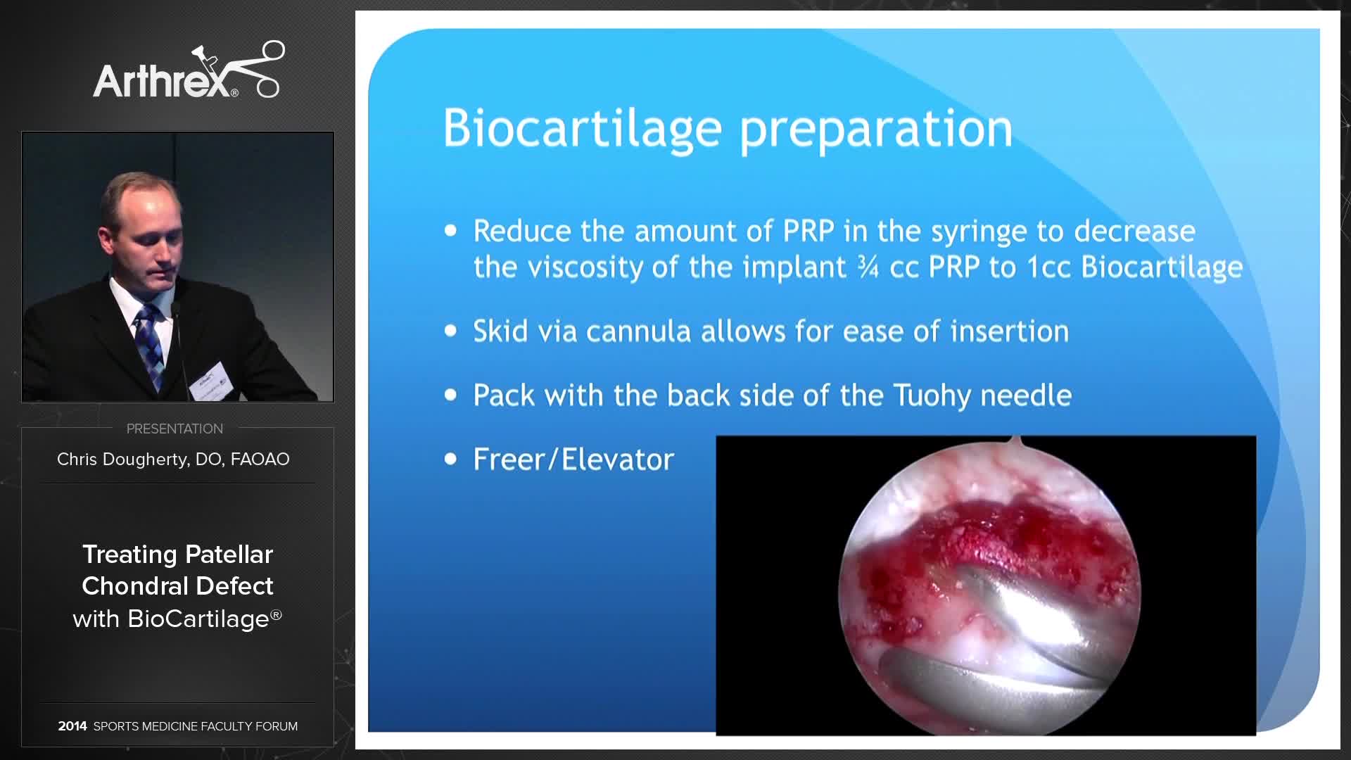 Arthrex - Treating Patellar Chondral Defect with BioCartilage®