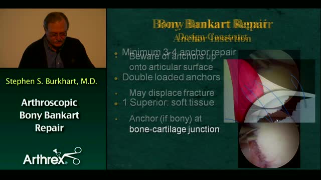 Arthrex - Arthroscopic Bony Bankart Repair