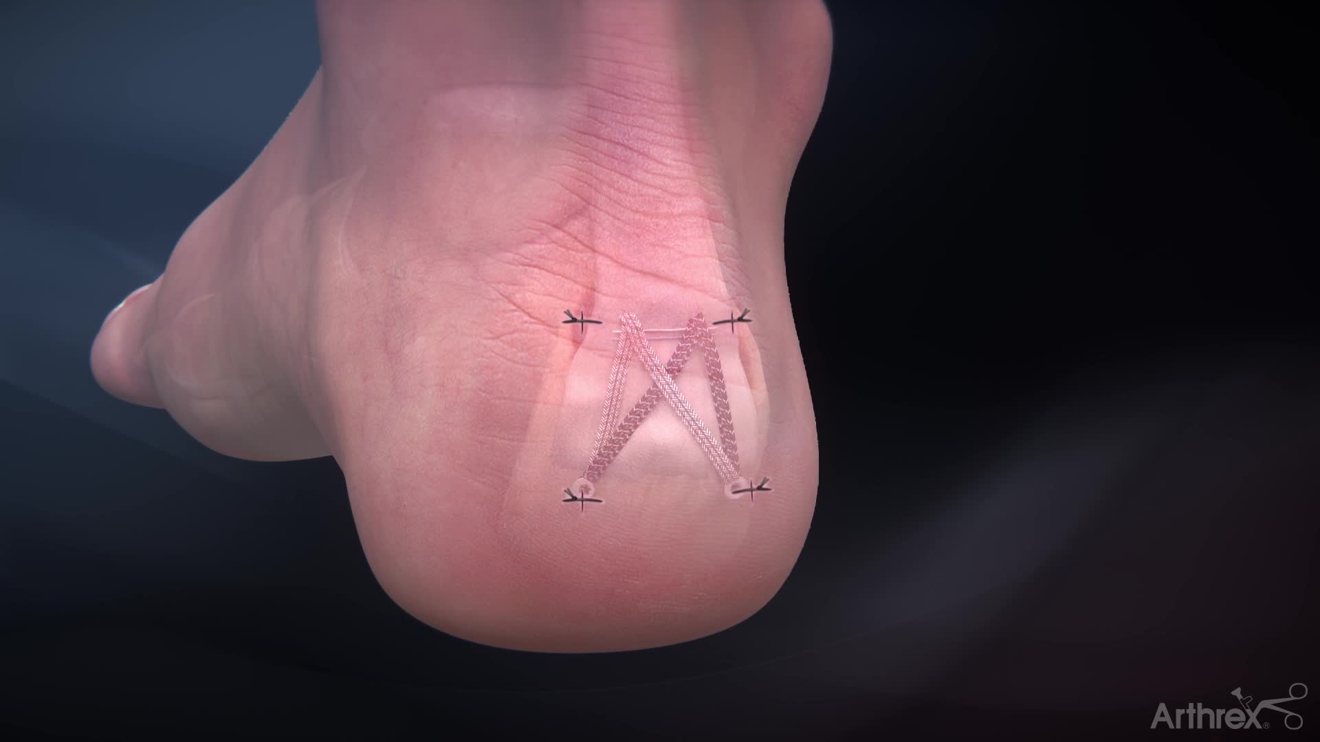 Arthrex - MIS FiberTak® Achilles SpeedBridge™ Tips and Pearls