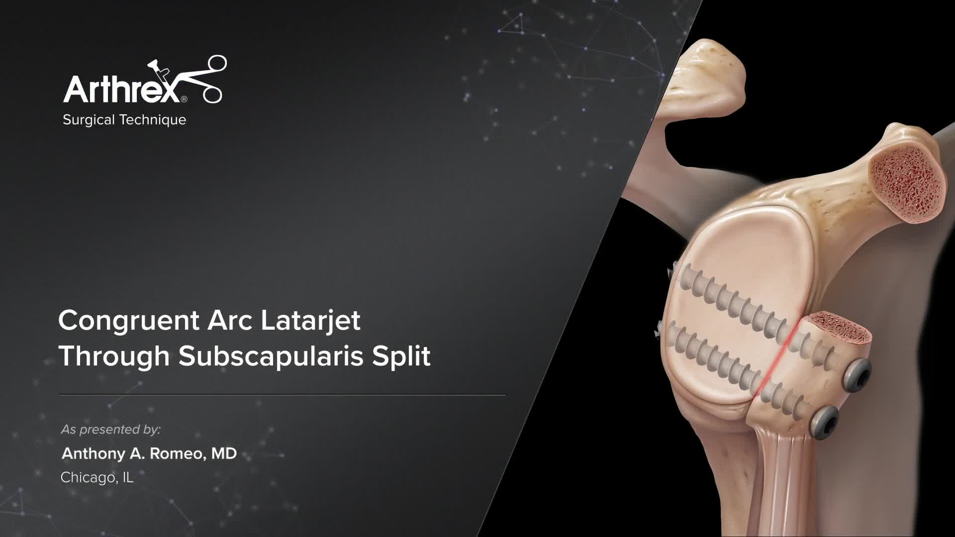 Arthrex - Congruent Arc Latarjet Through Subscapularis Split